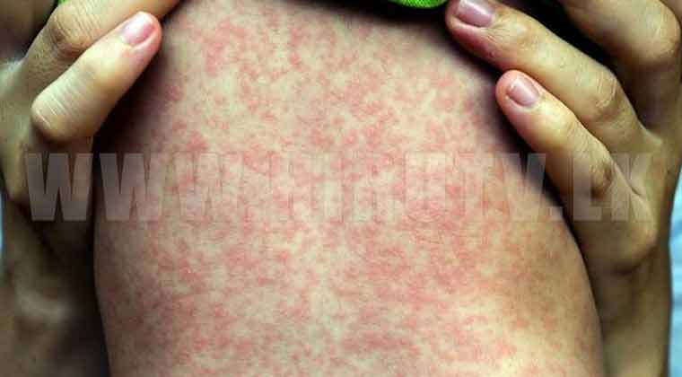 සරම්ප පැතිරීම තුන් ගුණයකින් ඉහළට|Hiru TV Blog